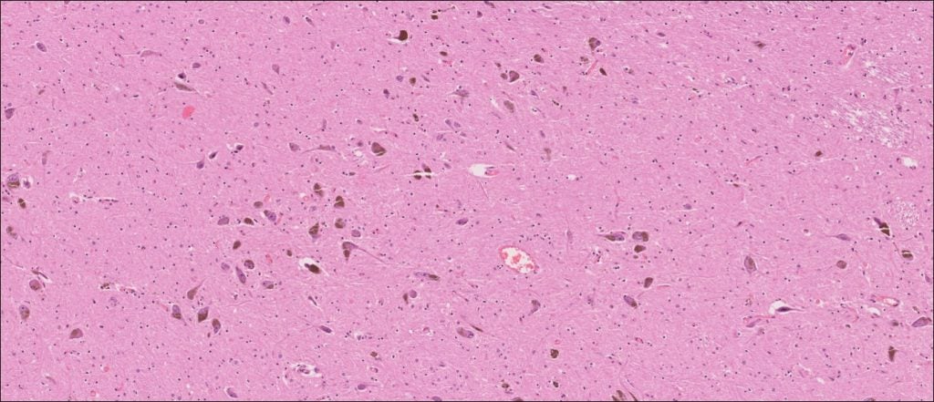 Brain – Midbrain – NUS Pathweb :: NUS Pathweb