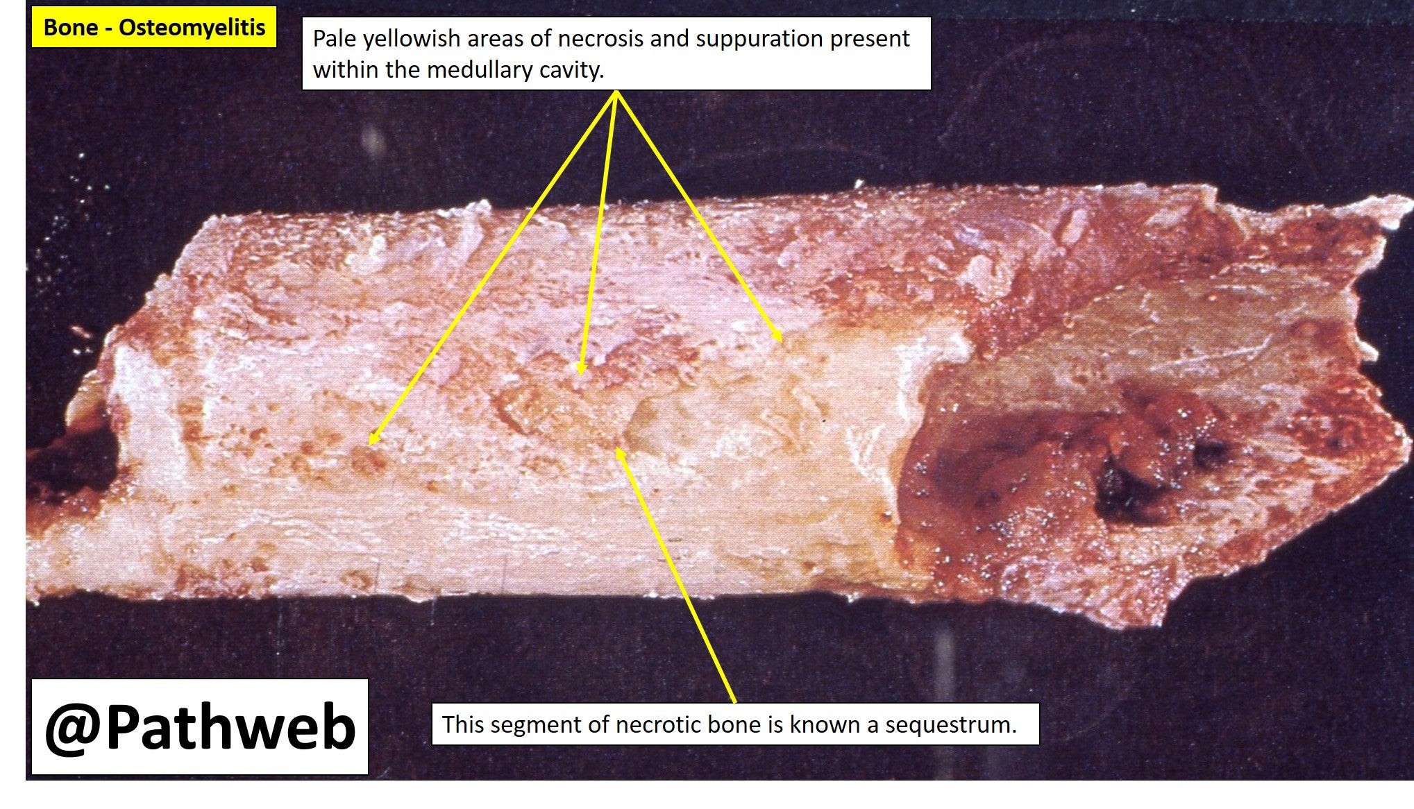 Bone – Osteomyelitis – NUS Pathweb :: NUS Pathweb