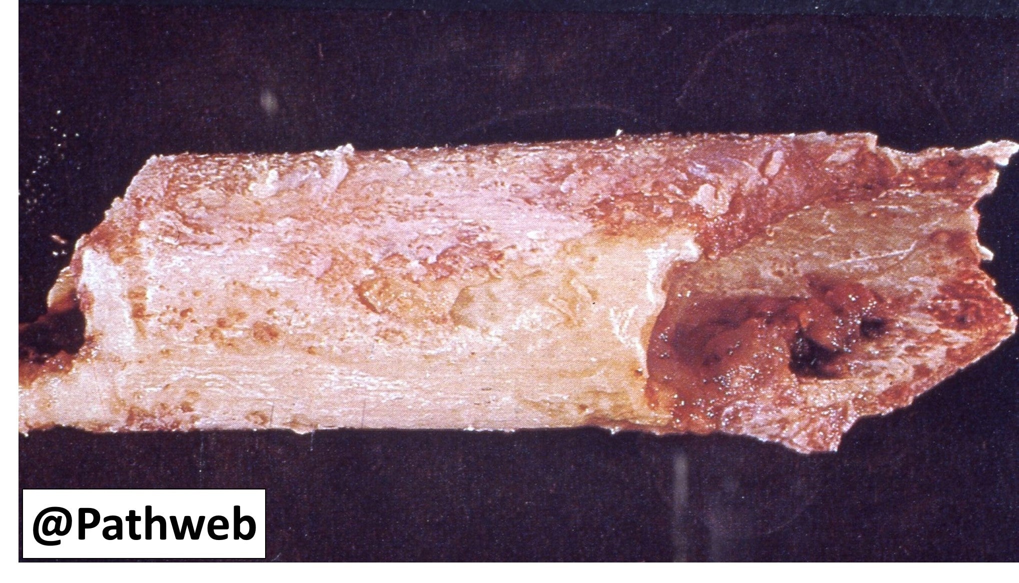 Bone – Osteomyelitis – NUS Pathweb :: NUS Pathweb