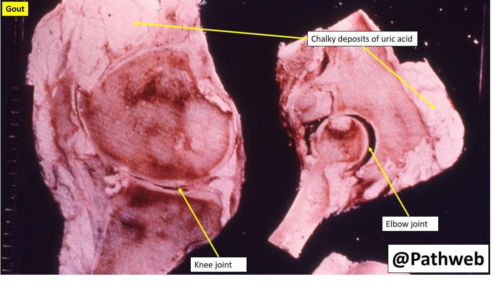 Finger – Gout – NUS Pathweb :: NUS Pathweb