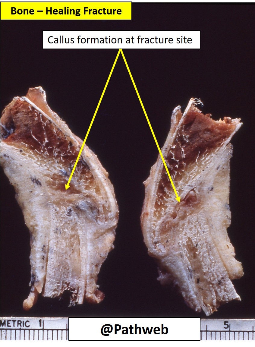 Long bone – Healing Fracture – NUS Pathweb :: NUS Pathweb