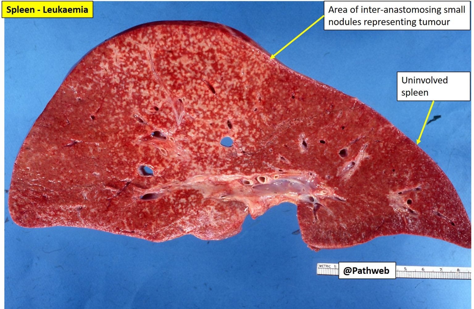Spleen – Leukaemia – NUS Pathweb :: NUS Pathweb