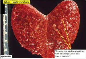 Spleen – Hodgkin Lymphoma – NUS Pathweb :: NUS Pathweb