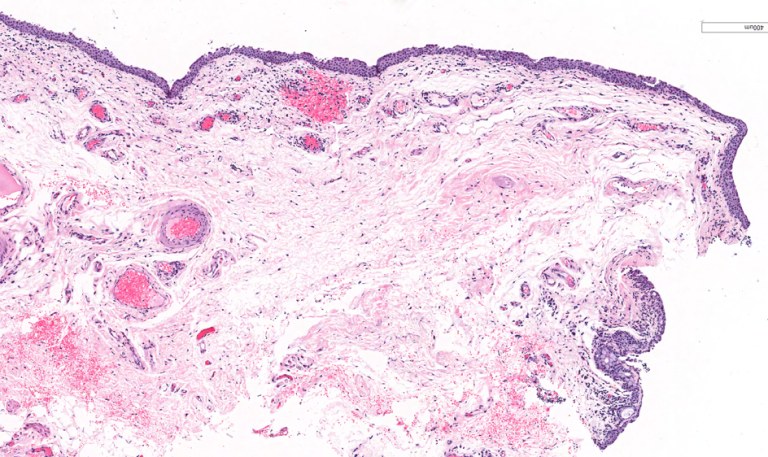 Eye – Conjunctiva – NUS Pathweb :: NUS Pathweb