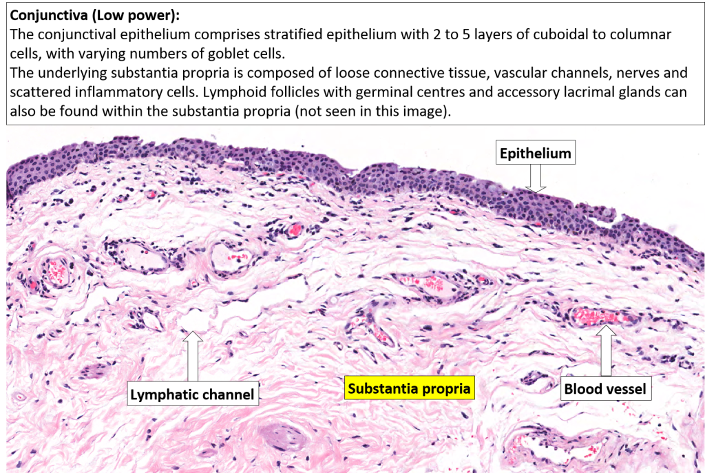 Eye – Conjunctiva – NUS Pathweb :: NUS Pathweb