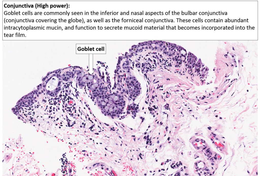Eye – Conjunctiva – NUS Pathweb :: NUS Pathweb