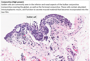Eye – Conjunctiva – NUS Pathweb :: NUS Pathweb