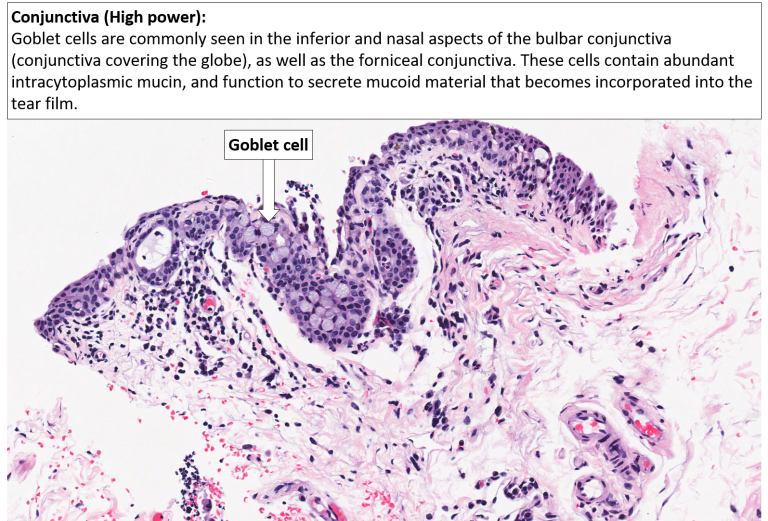 Eye – Conjunctiva – NUS Pathweb :: NUS Pathweb