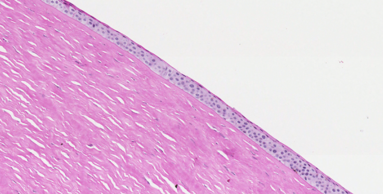 Eye – Cornea – NUS Pathweb :: NUS Pathweb