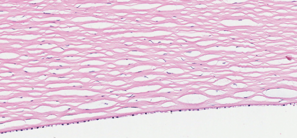 Eye – Cornea – NUS Pathweb :: NUS Pathweb