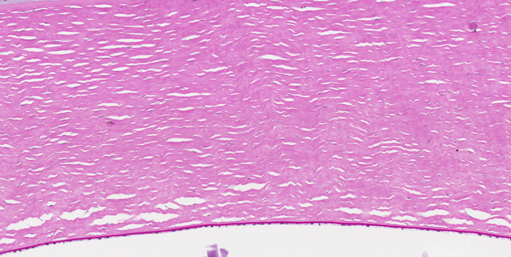 Eye – Cornea – NUS Pathweb :: NUS Pathweb