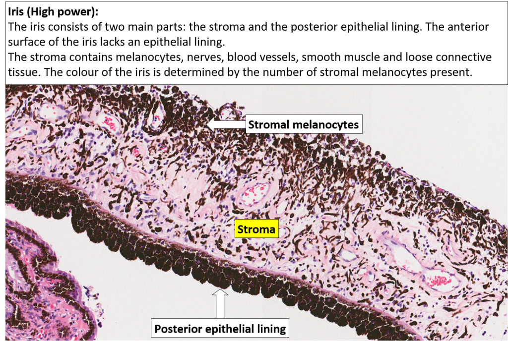Eye – Iris and Ciliary body – NUS Pathweb :: NUS Pathweb