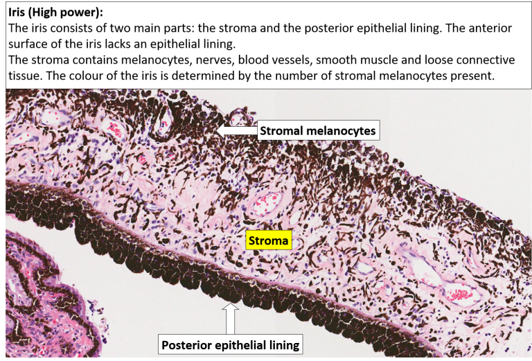 Eye – Iris and Ciliary body – NUS Pathweb :: NUS Pathweb