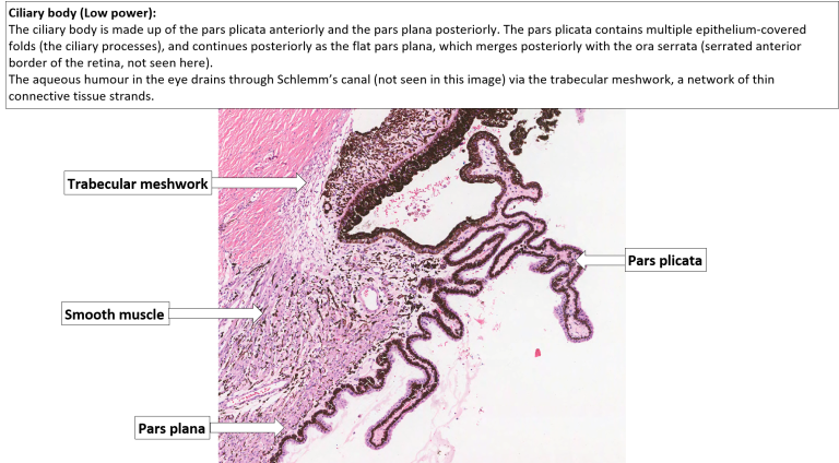 Eye – Iris and Ciliary body – NUS Pathweb :: NUS Pathweb