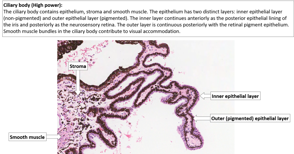 Eye – Iris and Ciliary body – NUS Pathweb :: NUS Pathweb
