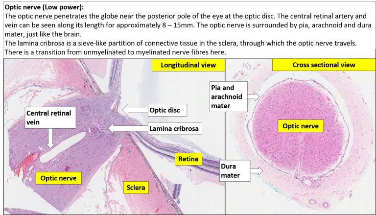 Eye – Optic nerve – NUS Pathweb :: NUS Pathweb