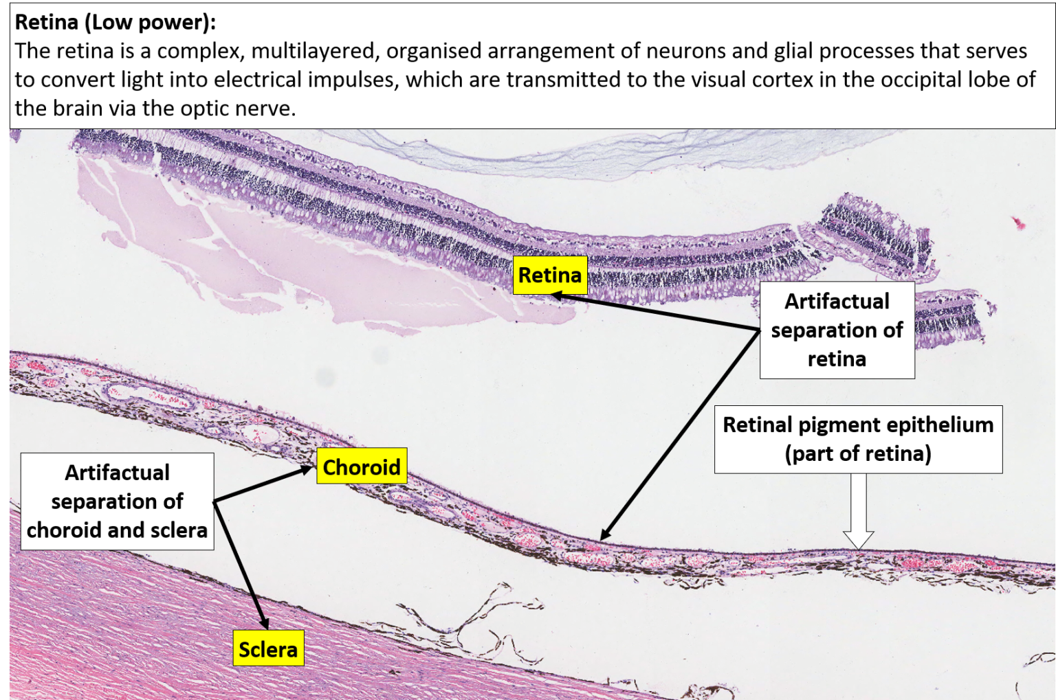 Eye – Retina, Choroid and Sclera – NUS Pathweb :: NUS Pathweb