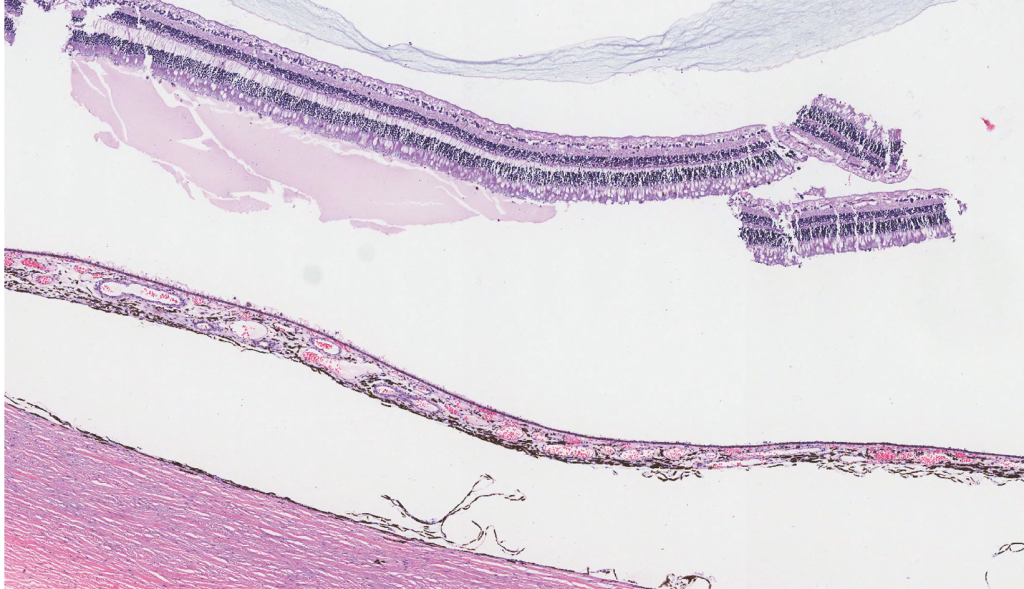 Eye – Retina, Choroid and Sclera – NUS Pathweb :: NUS Pathweb