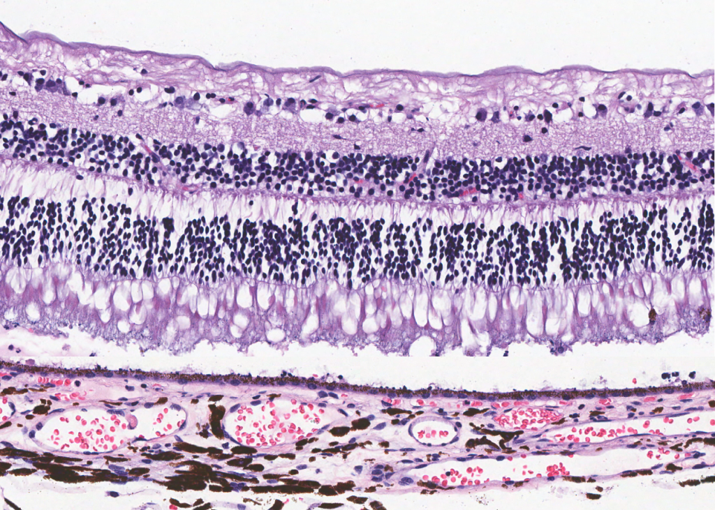 Eye – Retina, Choroid and Sclera – NUS Pathweb :: NUS Pathweb
