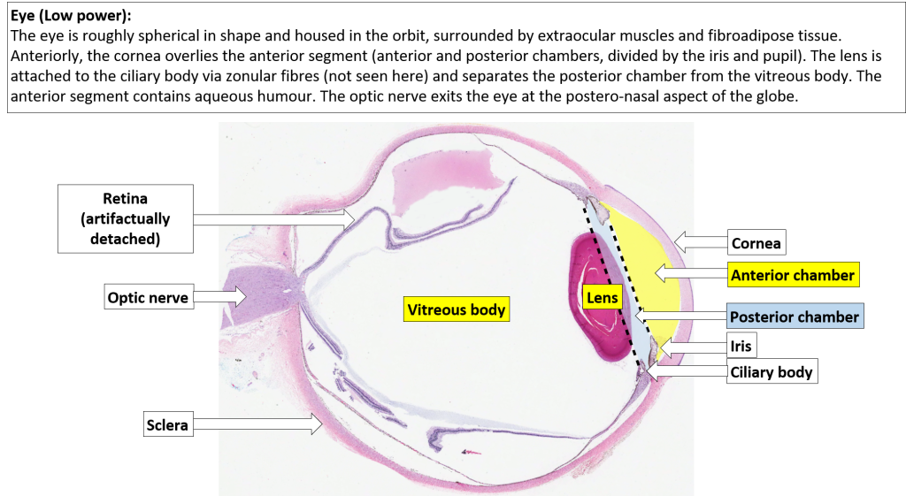 Eye – Whole globe – NUS Pathweb :: NUS Pathweb