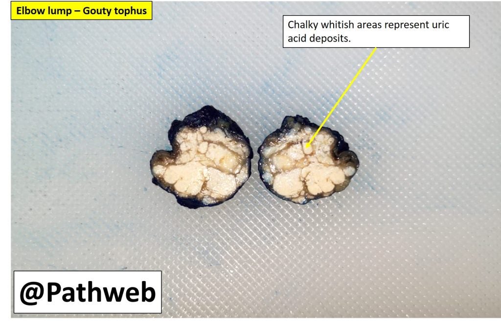 Finger – Gout – NUS Pathweb :: NUS Pathweb