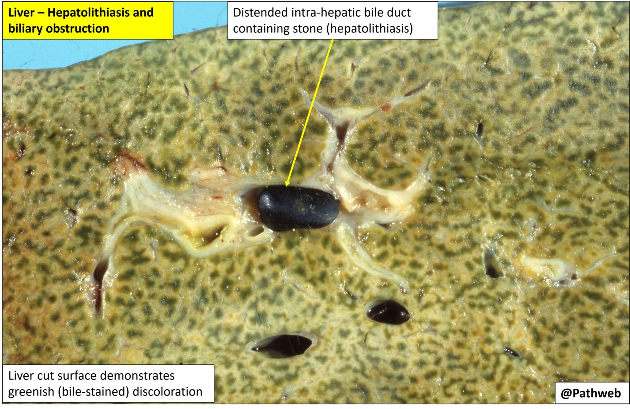 Liver – Choledocholithiasis – NUS Pathweb :: NUS Pathweb