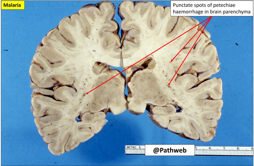 Brain – Malaria (Petechial Haemorrhage) – NUS Pathweb :: NUS Pathweb