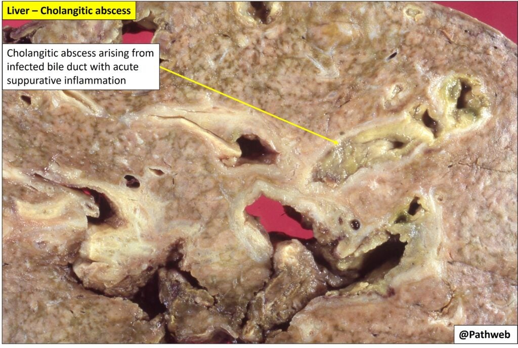 Liver – Cholangitic Abscess – NUS Pathweb :: NUS Pathweb
