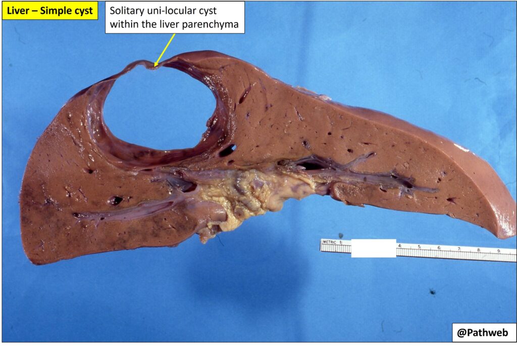 Liver – Cyst – NUS Pathweb :: NUS Pathweb