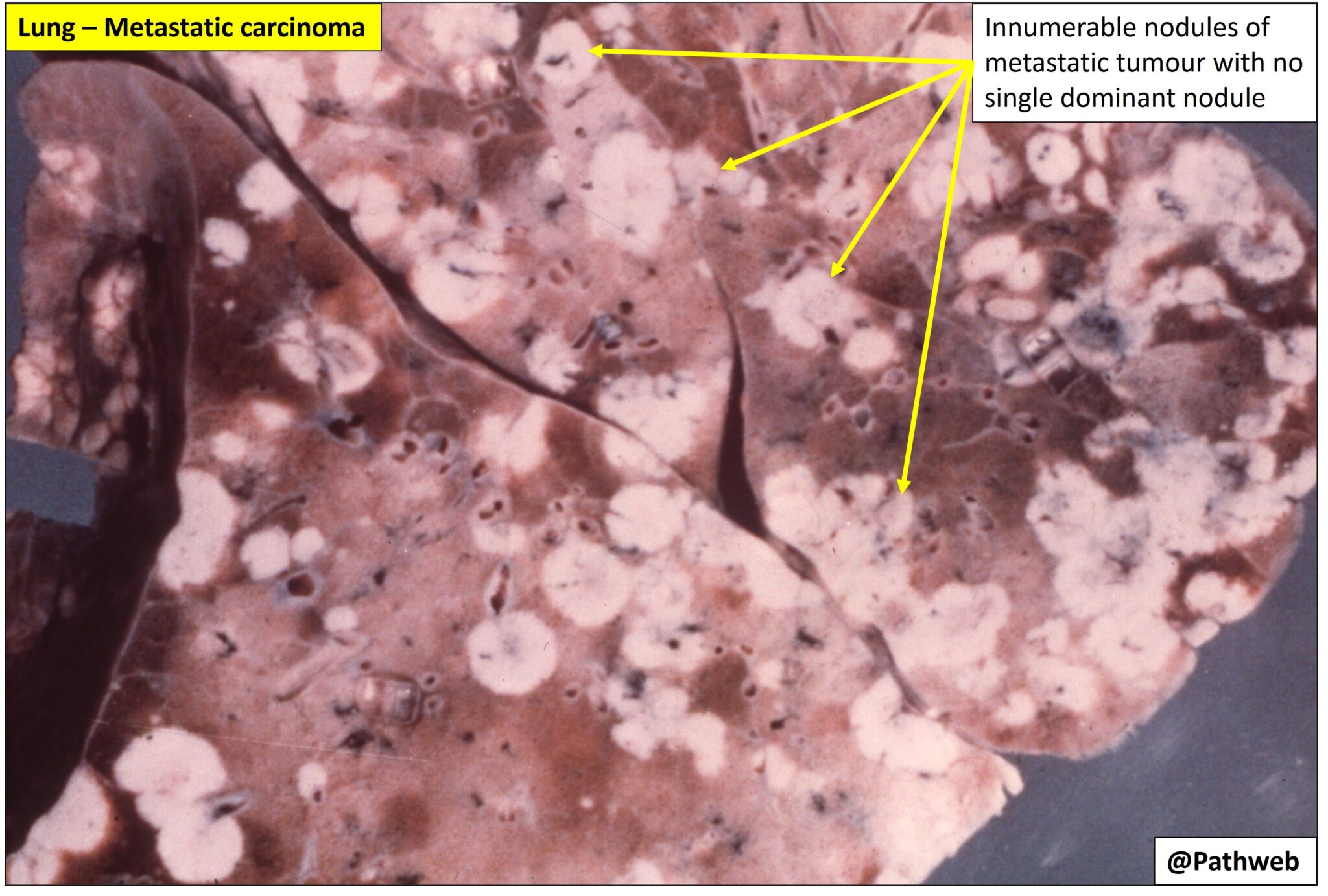 Lung – Metastatic Carcinoma – NUS Pathweb :: NUS Pathweb