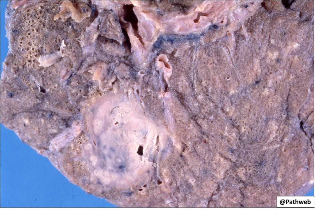 Lung and Lymph Nodes – Tuberculosis with Primary Complex – NUS Pathweb ...