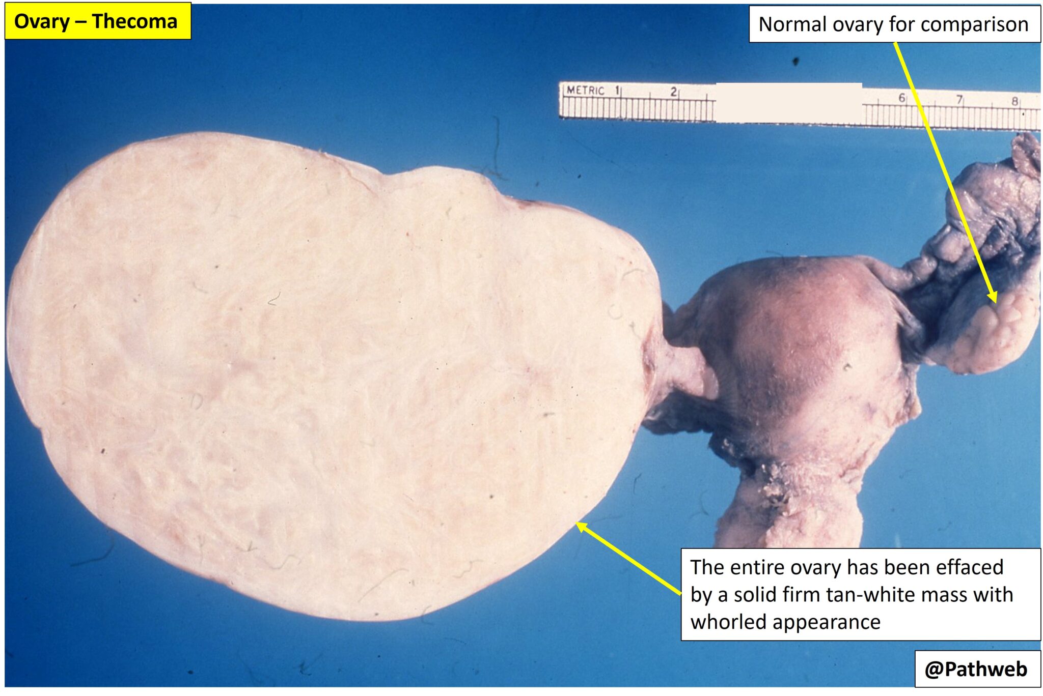 Ovary – Thecoma – NUS Pathweb :: NUS Pathweb