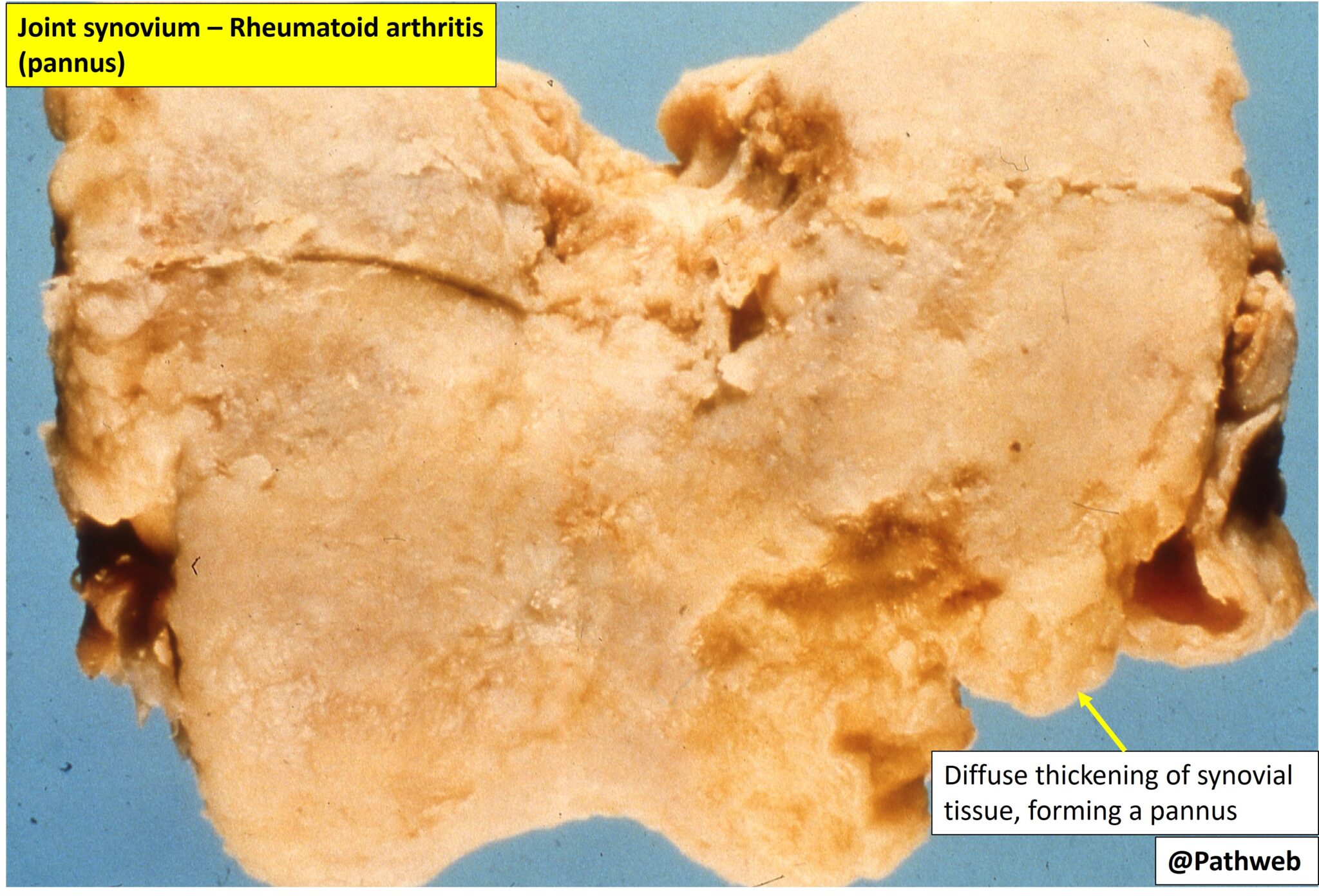 Tibia – Rheumatoid Arthritis – NUS Pathweb :: NUS Pathweb