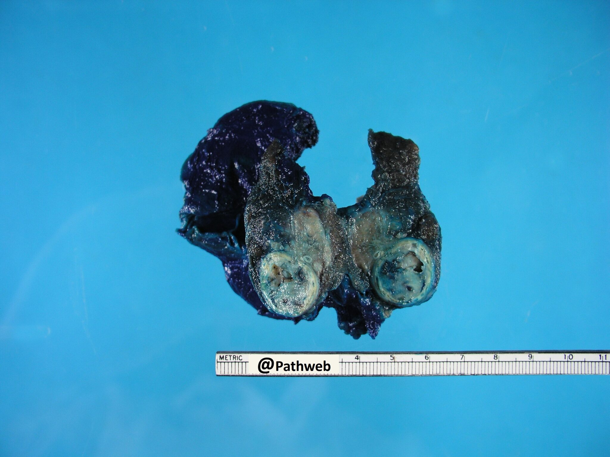 Thyroid – Follicular Carcinoma – NUS Pathweb :: NUS Pathweb