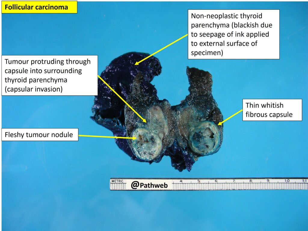 Thyroid – Follicular Carcinoma – NUS Pathweb :: NUS Pathweb