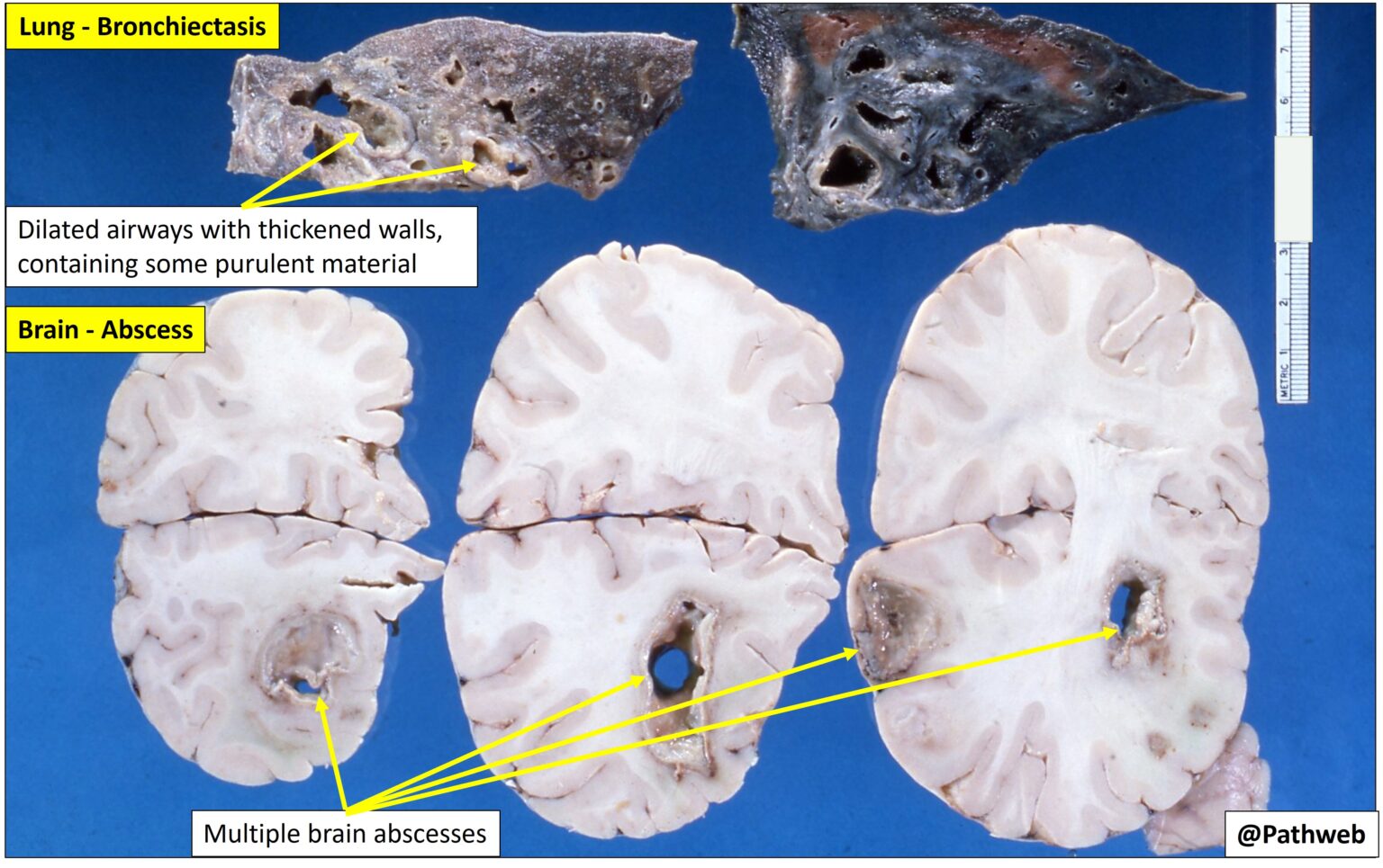 Brain – Abscess. Lung – Bronchietasis – NUS Pathweb :: NUS Pathweb