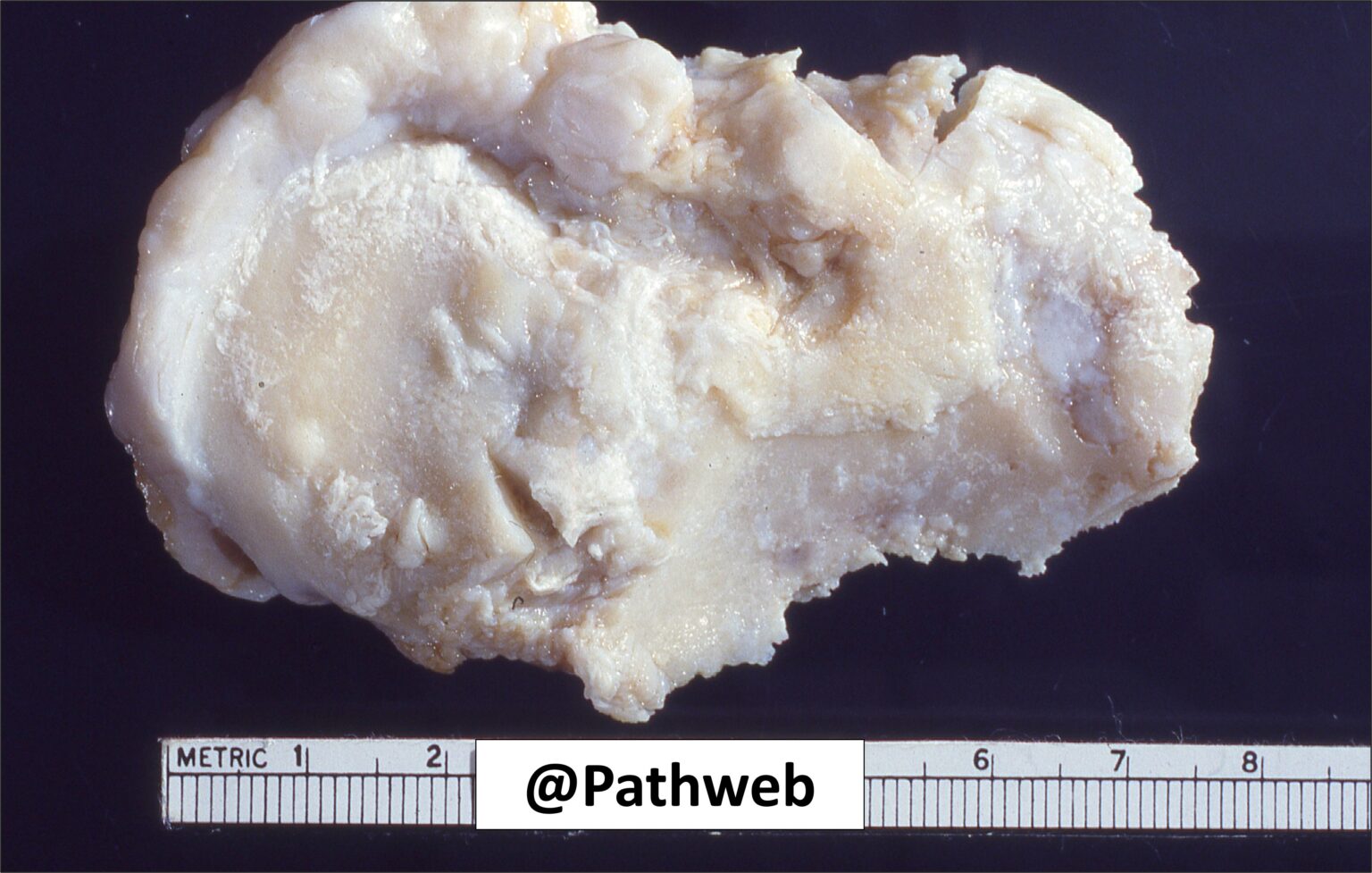 Tibia – Osteoarthritis – NUS Pathweb :: NUS Pathweb