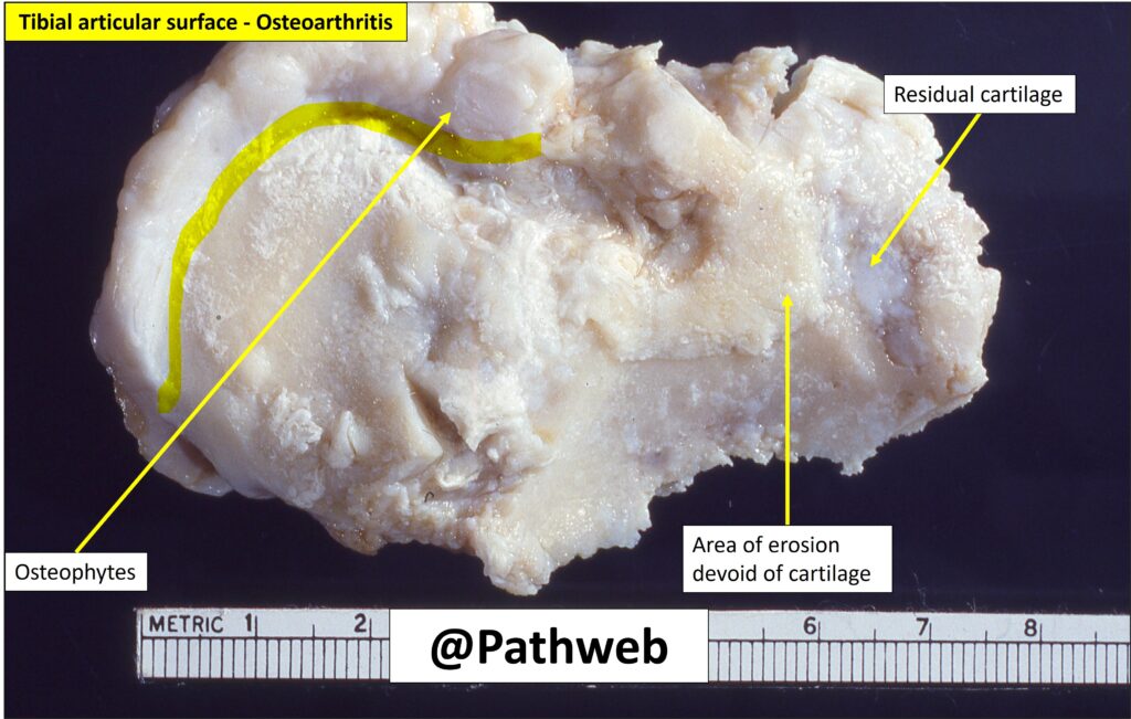 Tibia – Osteoarthritis – NUS Pathweb :: NUS Pathweb