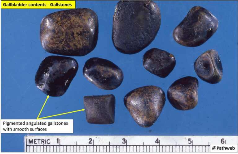 Gallstone from choledochal cyst – NUS Pathweb :: NUS Pathweb