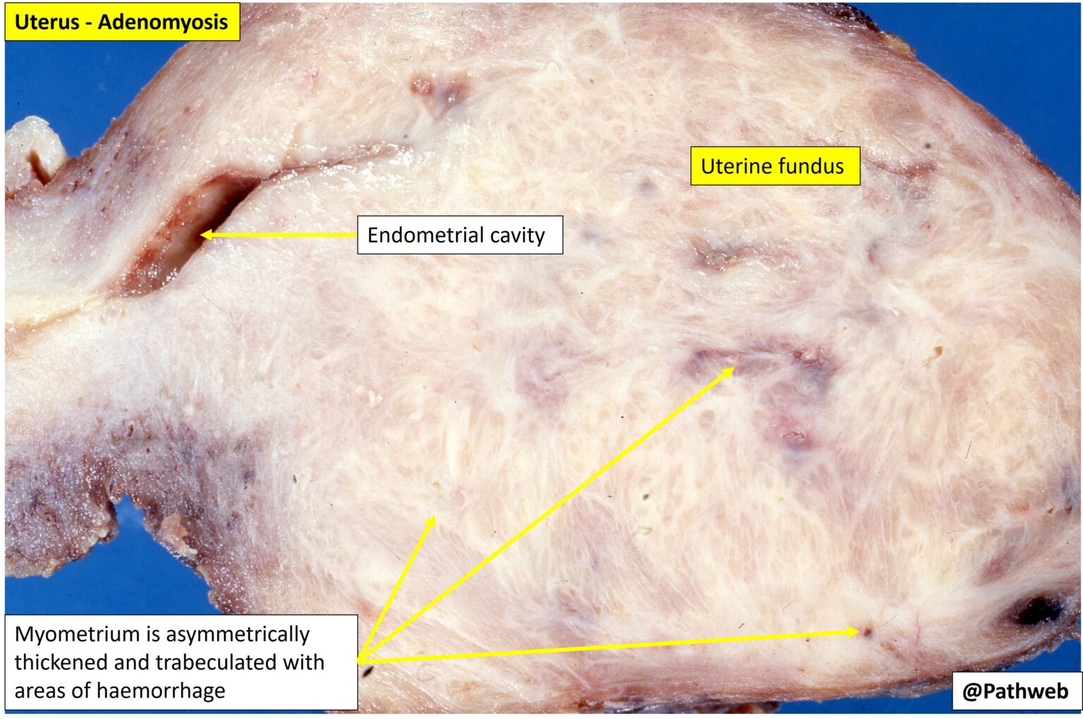 Uterus – Adenomyosis – NUS Pathweb :: NUS Pathweb
