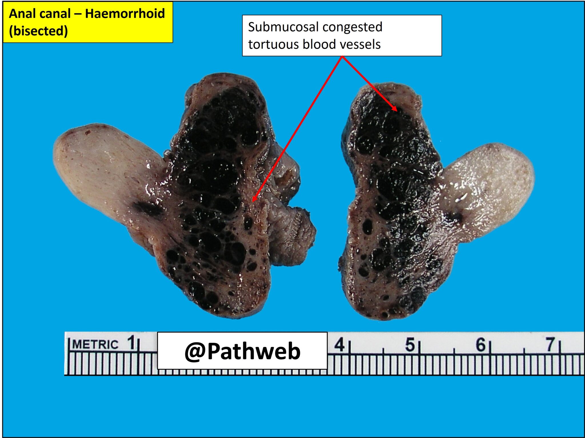 Anal canal – Haemorrhoids – NUS Pathweb :: NUS Pathweb