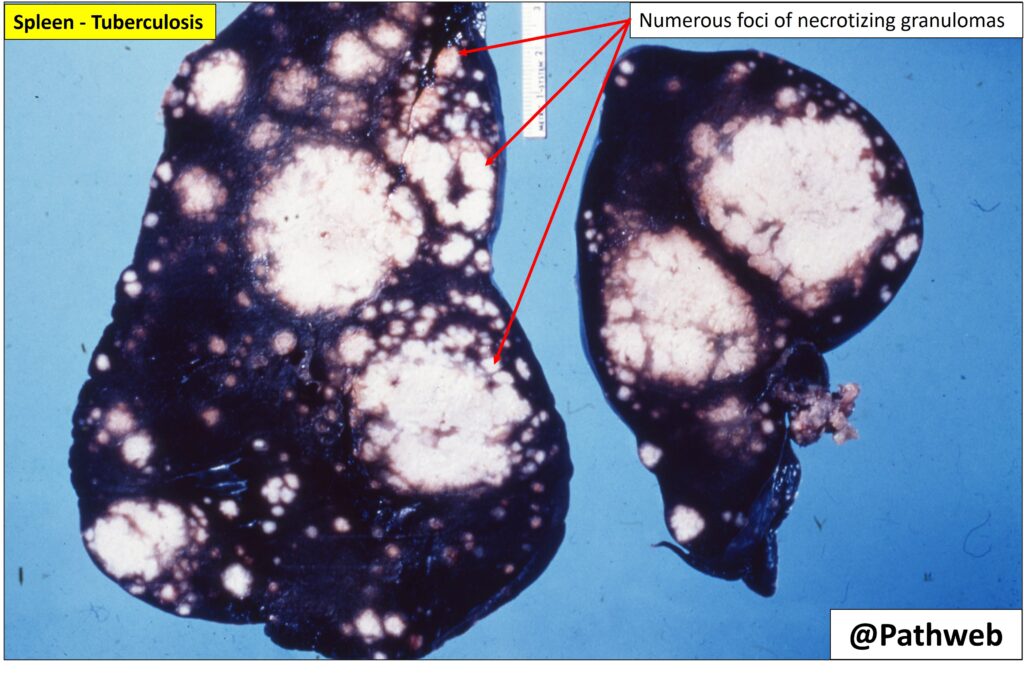 Spleen – Tuberculosis – NUS Pathweb :: NUS Pathweb