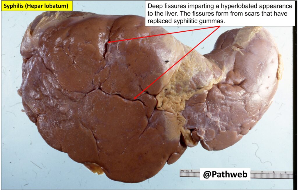 Liver – Syphilis (Hepar Lobatum) – NUS Pathweb :: NUS Pathweb