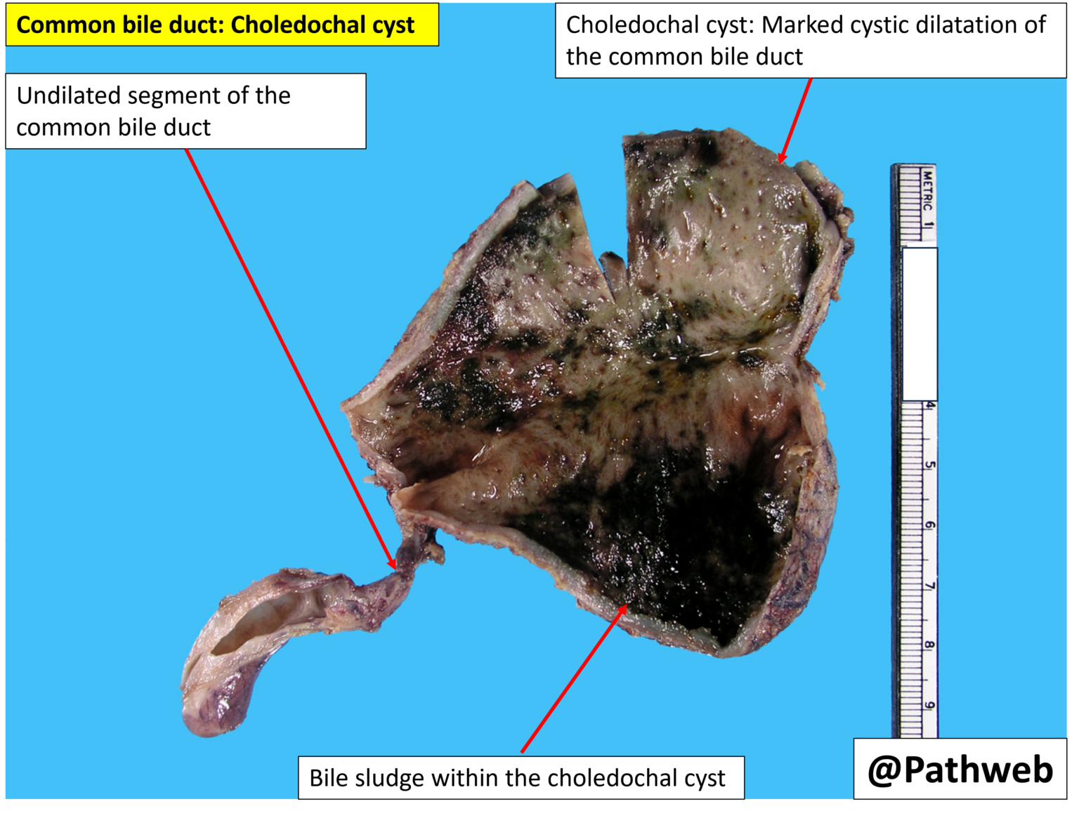 Liver – Choledochal cysts – NUS Pathweb :: NUS Pathweb