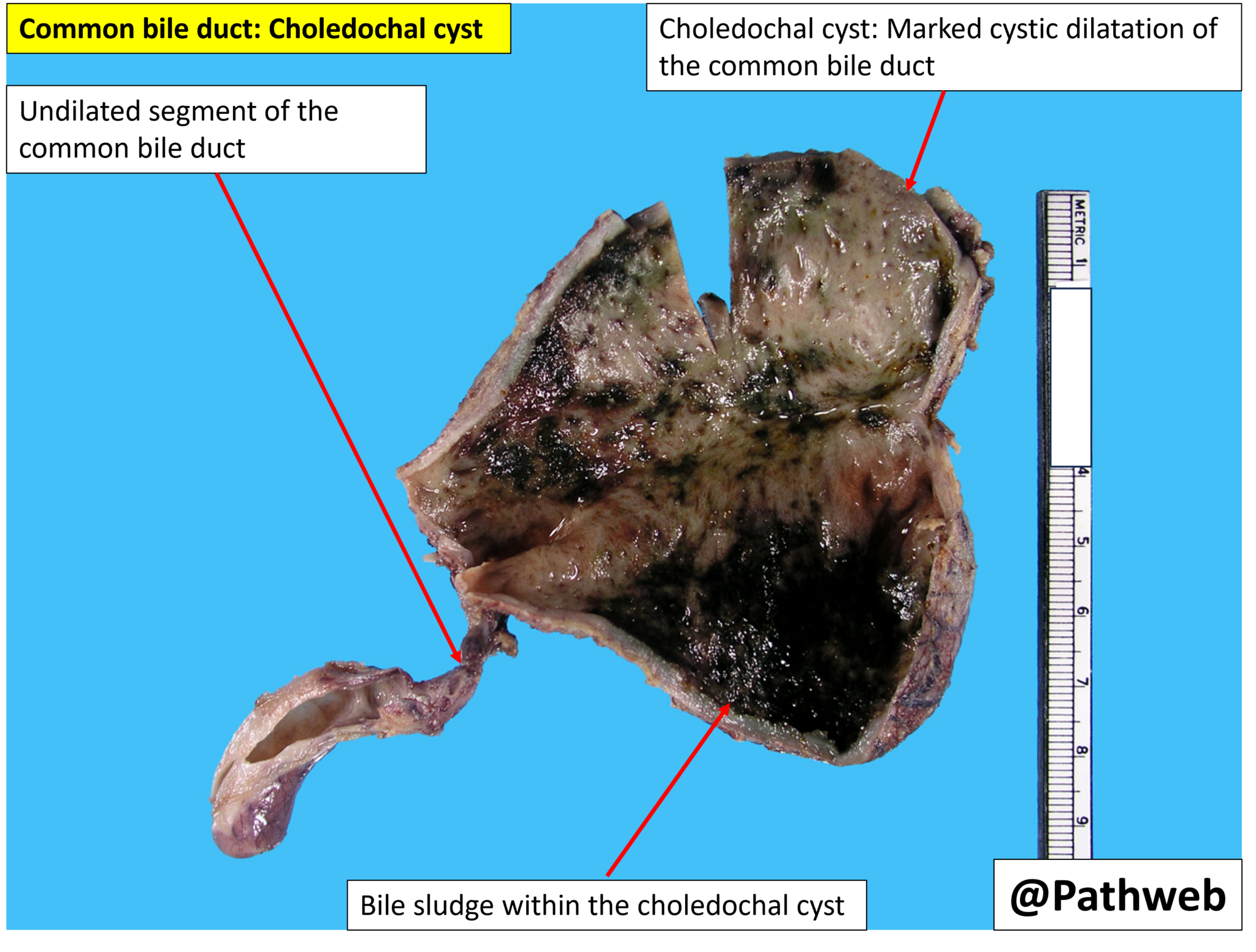 Liver – Choledochal cysts – NUS Pathweb :: NUS Pathweb