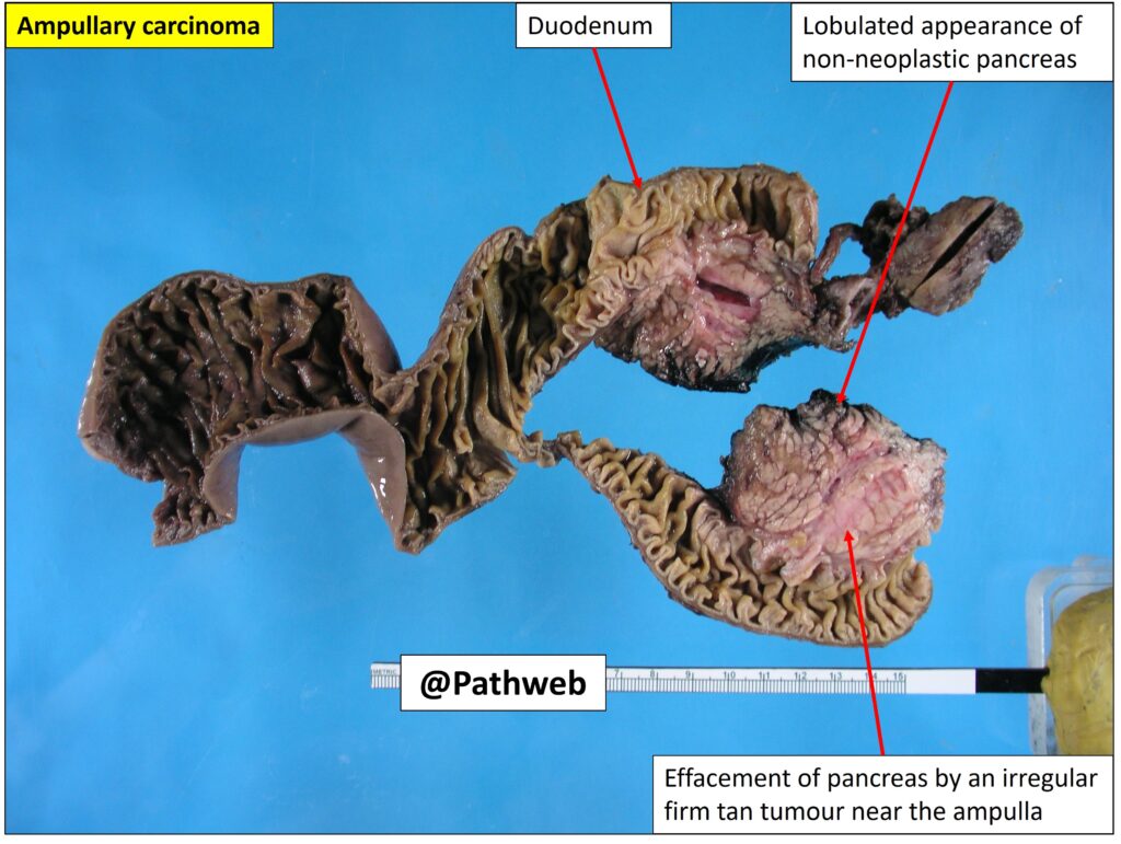 Duodenum and Pancreas – Ampullary Carcinoma – NUS Pathweb :: NUS Pathweb