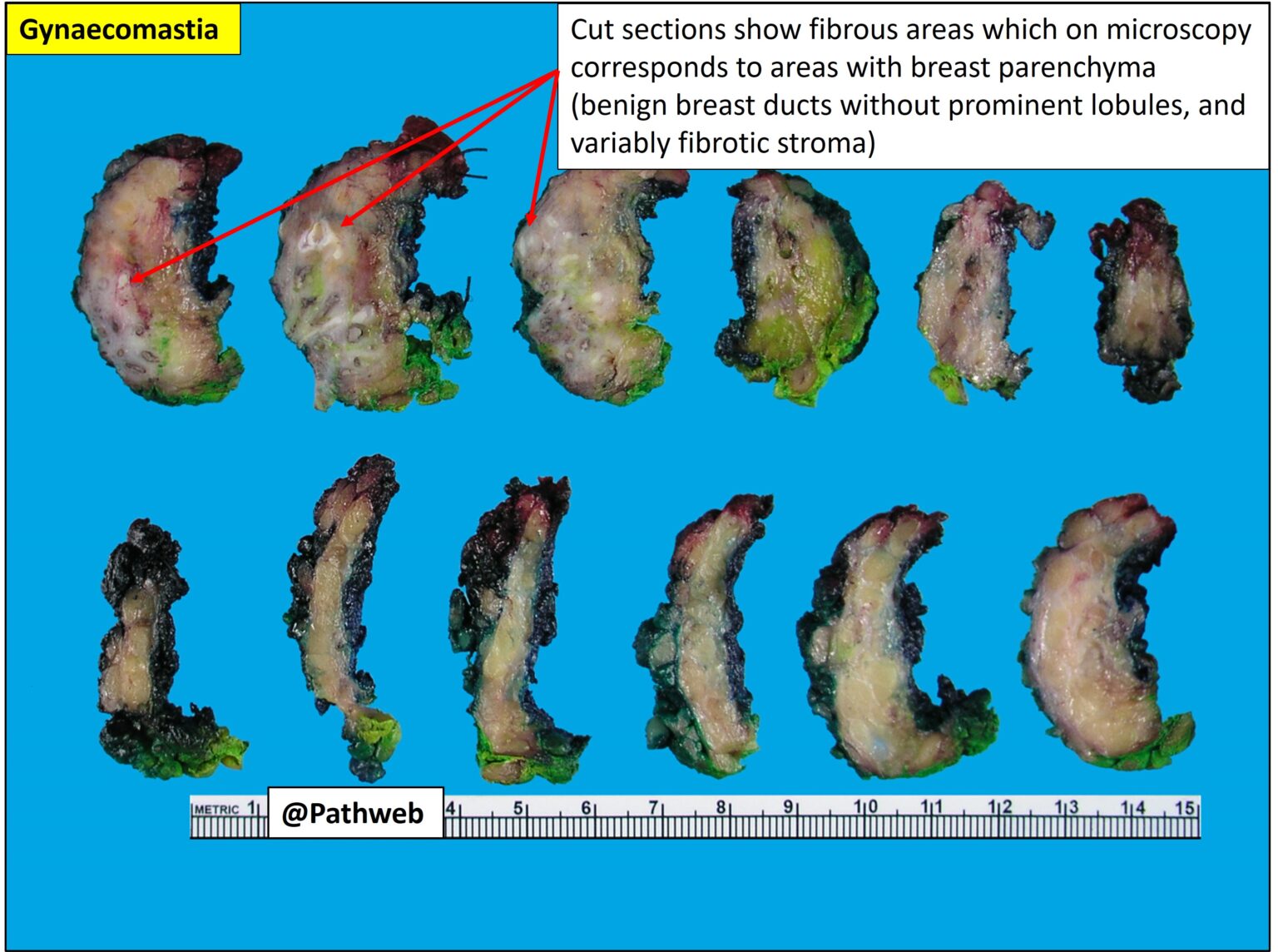 Breast (Male) – Gynaecomastia – NUS Pathweb :: NUS Pathweb