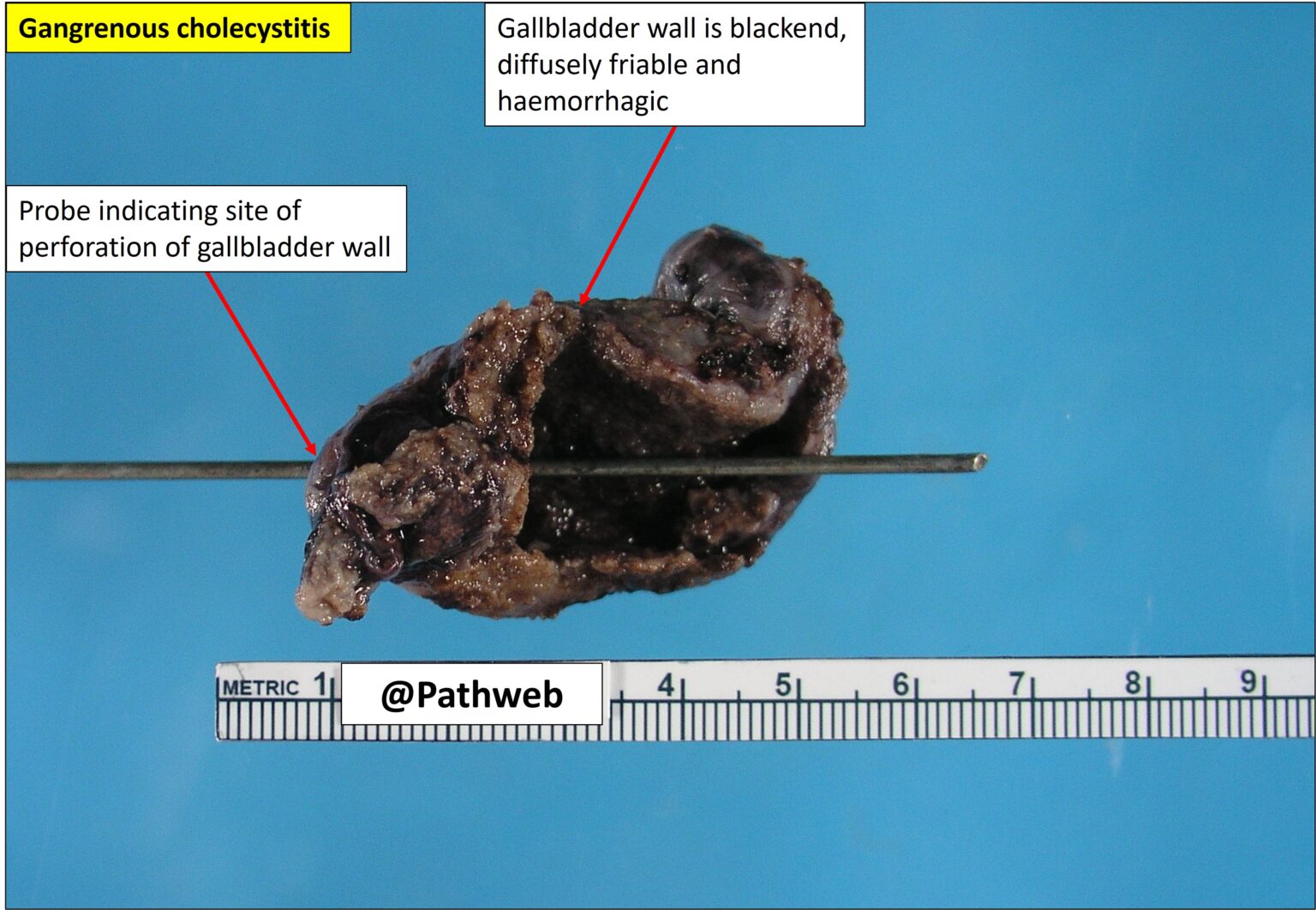 Gallbladder – Gangrenous cholecystitis – NUS Pathweb :: NUS Pathweb