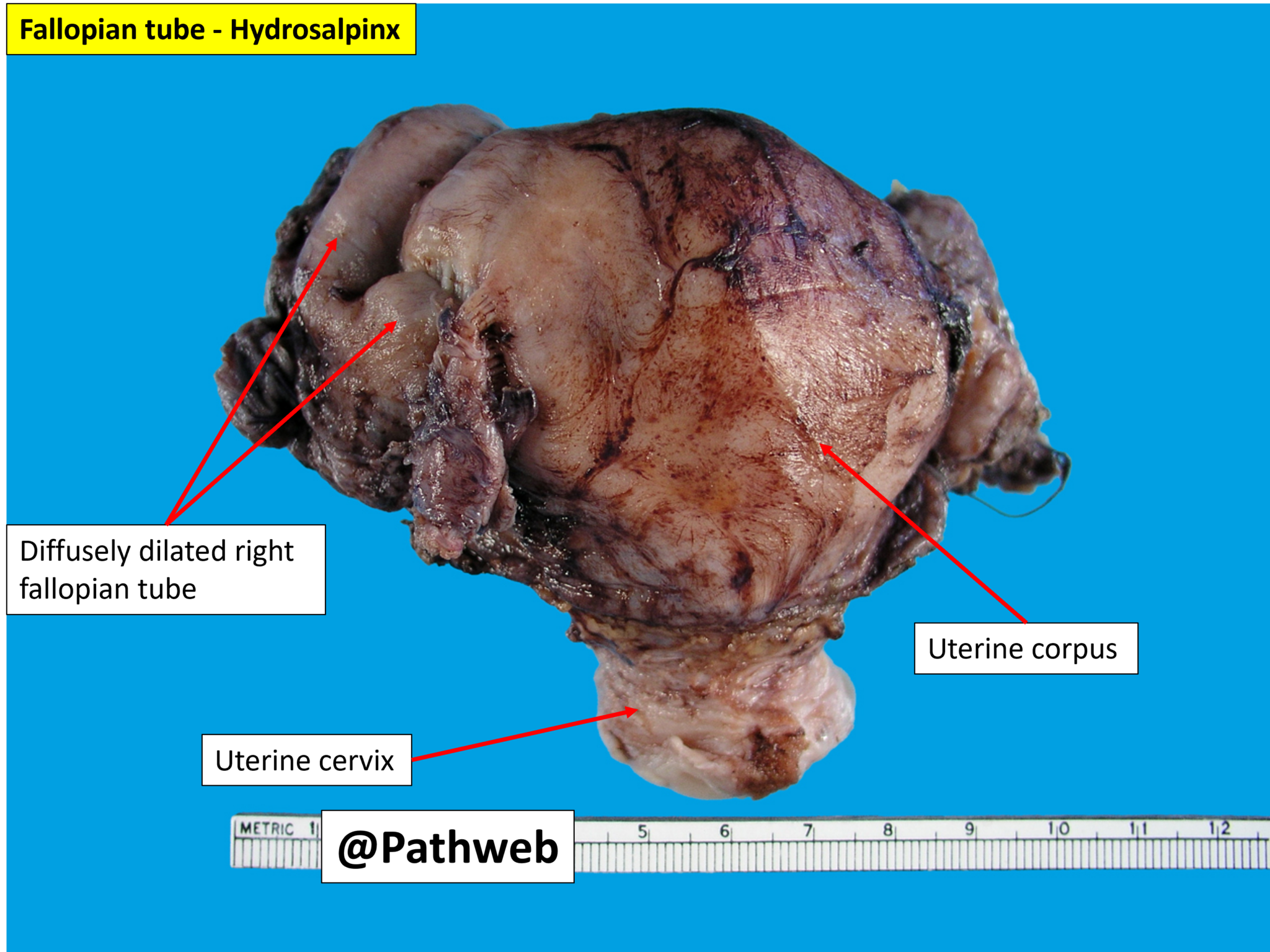 Fallopian Tube – Hydrosalpinx – NUS Pathweb :: NUS Pathweb