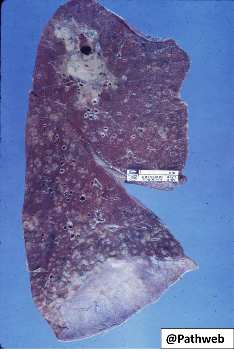 Lung and Larynx – Tuberculosis – NUS Pathweb :: NUS Pathweb